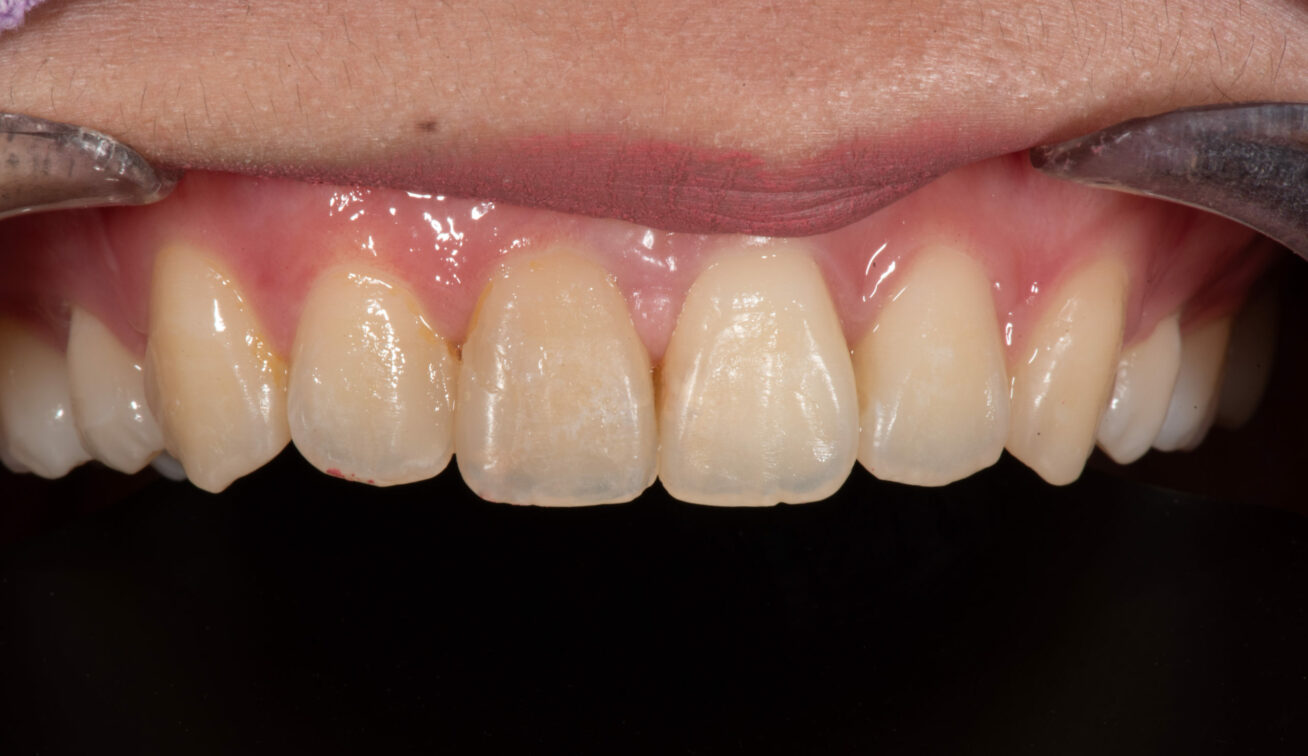 Nécrose Dentaire : Comprendre cette Affection