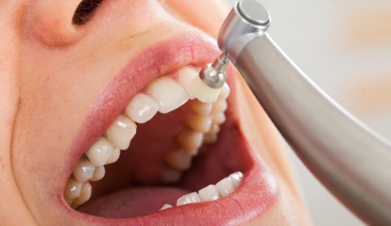 Prophylaxie Dentaire : Soins Préventifs - Centre Dentaire Voltaire